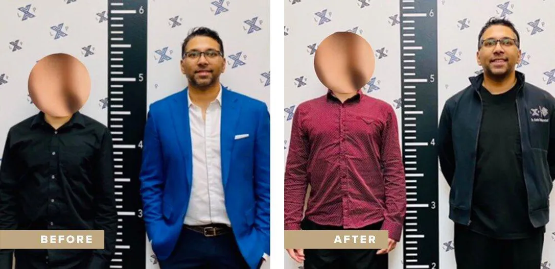 Height surgery is a booming trend in Canada, especially among men. Is ...